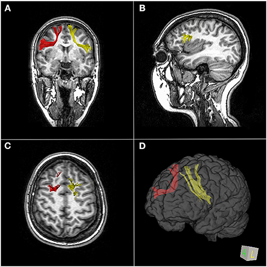 Frontaler Aslant Trakt Ars Neurochirurgica