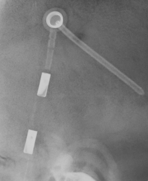 Integra Differential Pressure (DP) Shuntsystem - Ars Neurochirurgica